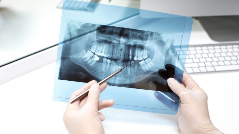D6010 Dental Code: Everything You Need to Know